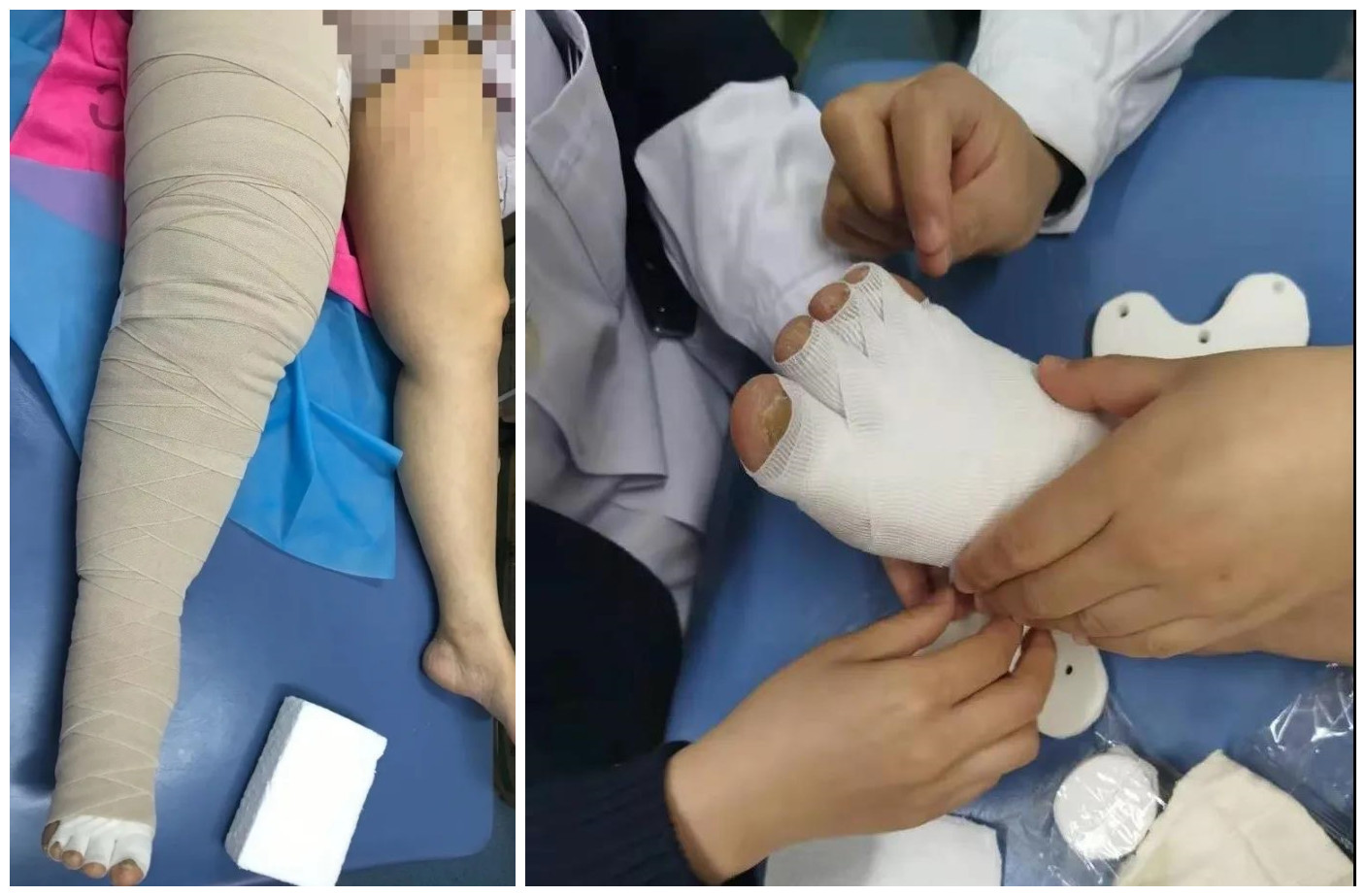康复医学科丨还我一双美腿——综合消肿疗法的开展 科室新闻 欢迎光临安徽省第二人民医院